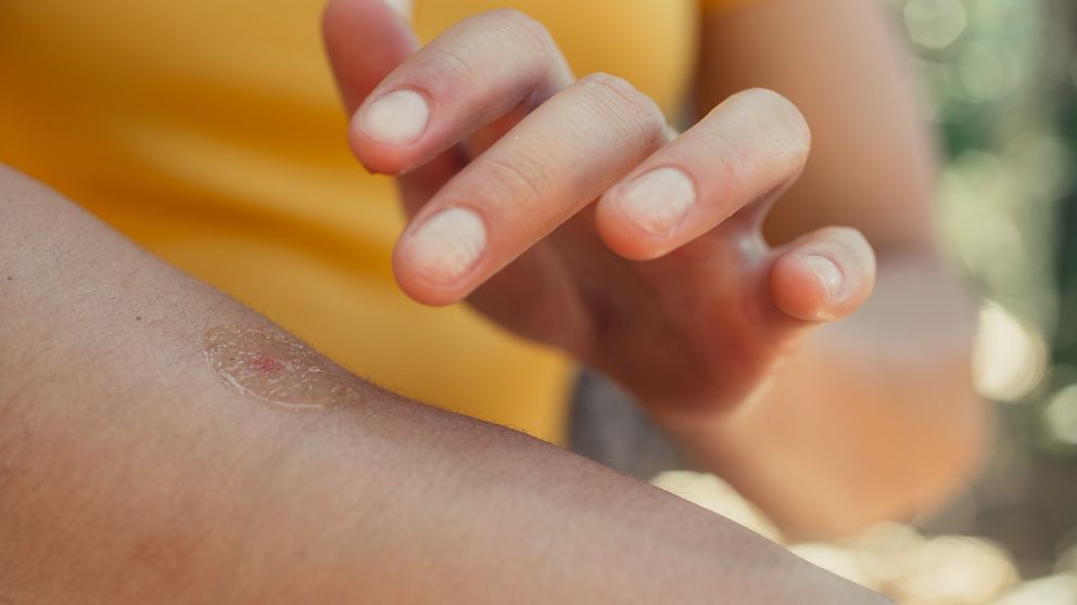 how to treat burns, bites and bruises - Magazine - Weleda
